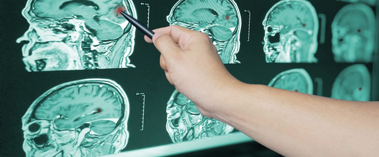 Mild Neurocognitive Disorder Due To Traumatic Brain Injury